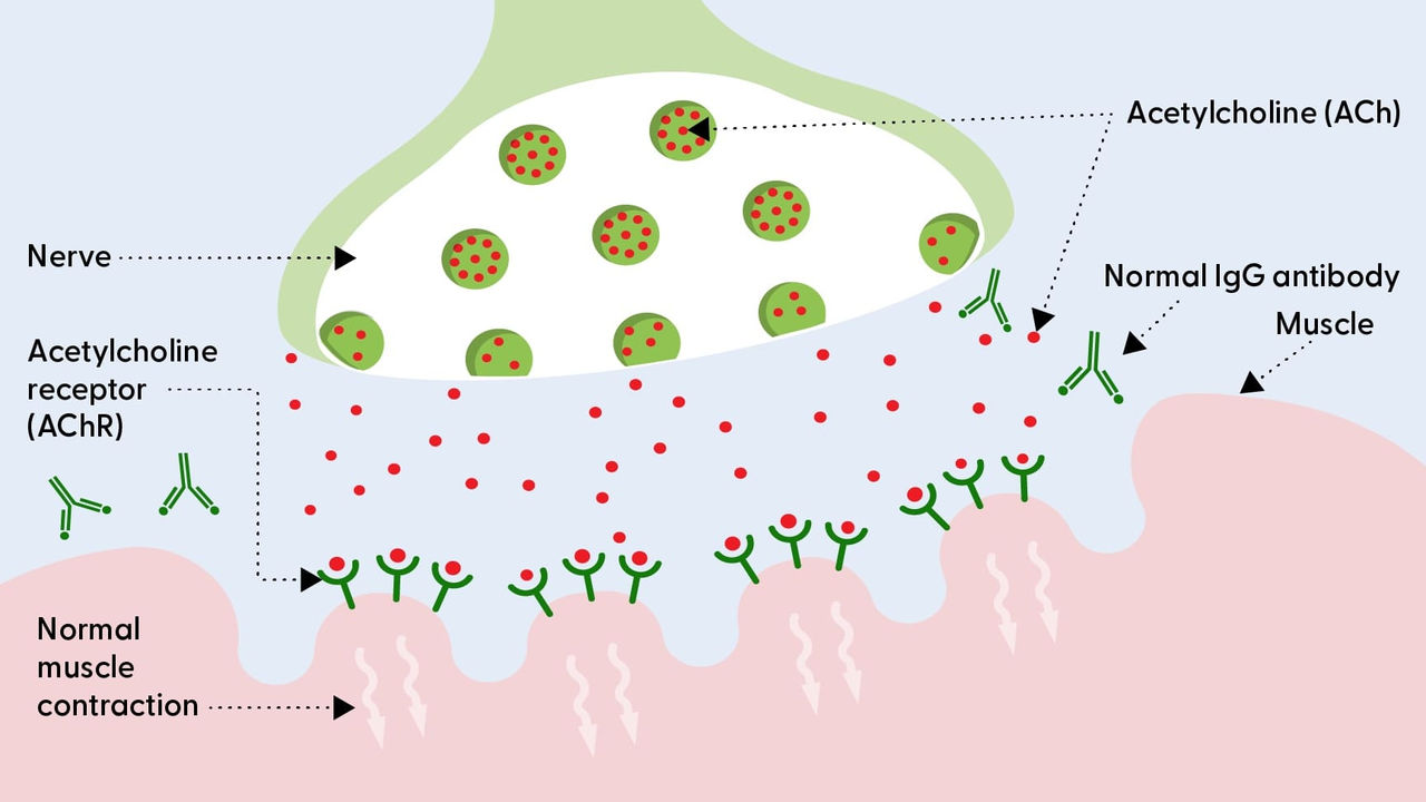 What Is Myasthenia Gravis, and Why Does It Happen? | MG United